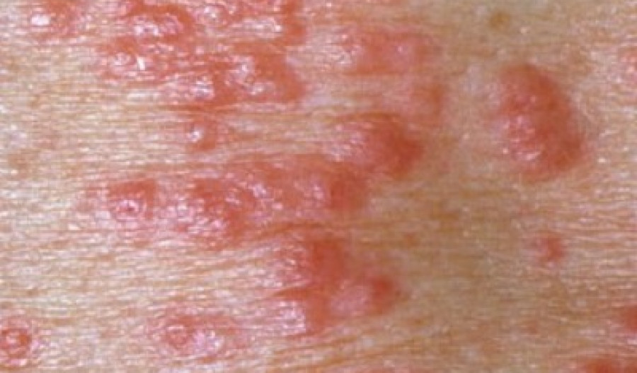 Scabies Rash