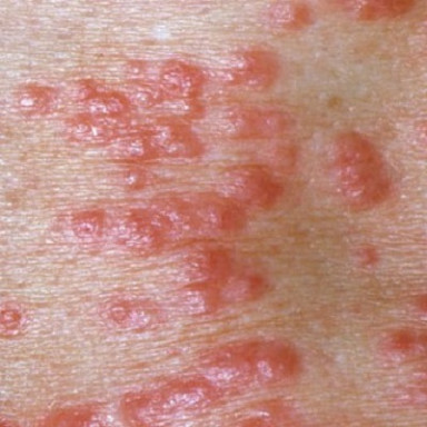 How to Get Rid of House Dust Mites | Kiwicare