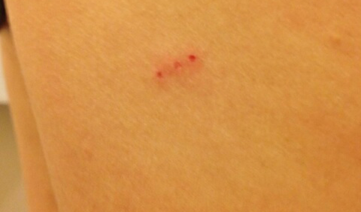 Bite Marks - Prevention of Bite Marks. | Kiwicare